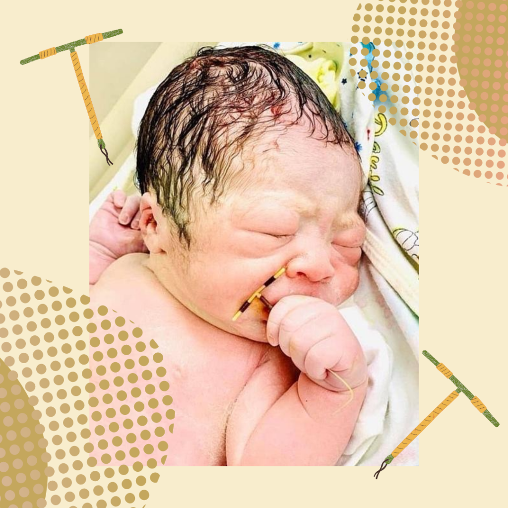 When IUDs Fail or Become Misplaced: Risks to Pregnant Moms and Babies ...